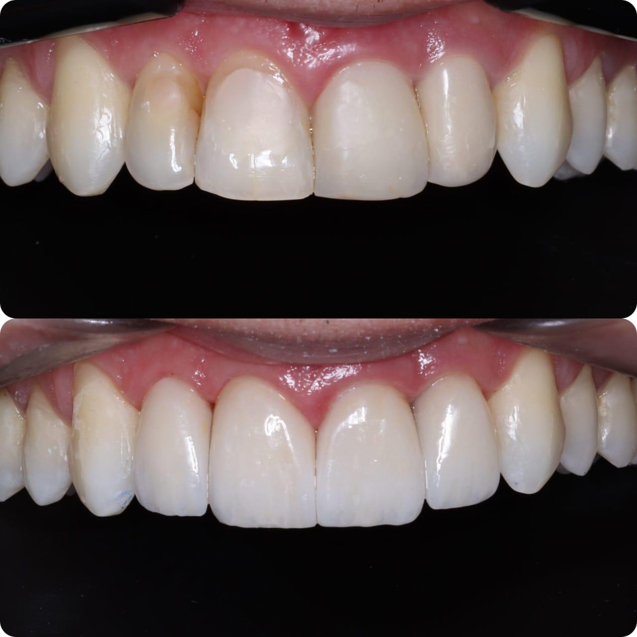 Facetas Dentárias: Transforme seu sorriso com naturalidade - Viu ...